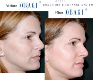 Obagi® Before and After Pictures – Micki Ly M.D. Maui Dermatologist