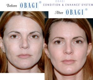 Obagi® Before and After Pictures – Micki Ly M.D. Maui Dermatologist