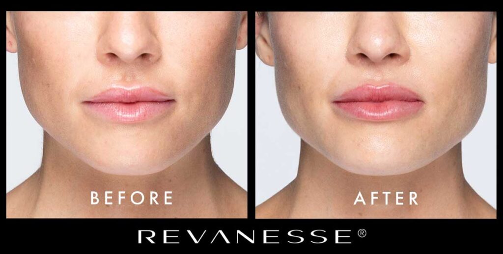 Revanesse® Versa™+ – Micki Ly M.D. Maui Dermatologist